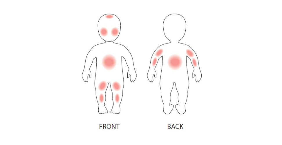Diagnosis of Atopic Dermatitis
